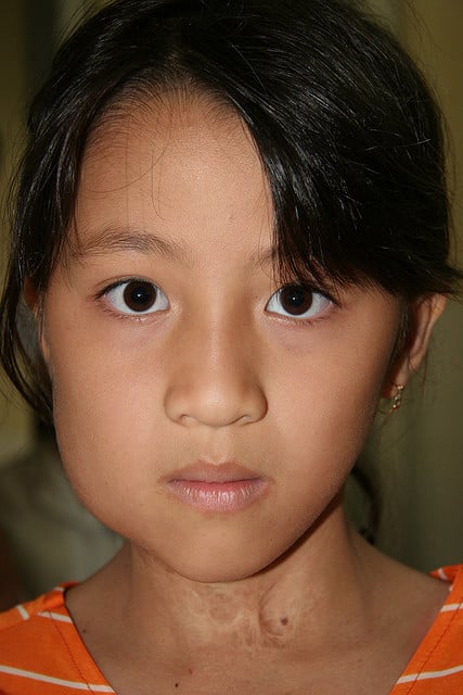 Quais os Sintomas da Caxumba? | Famivita