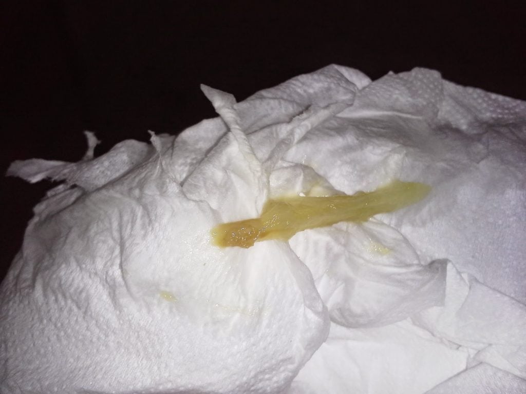 Tampão Mucoso: O Que É - E Como Identificar